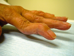 Rheumatoide Arthritis: Behandlung kommt oft zu spät